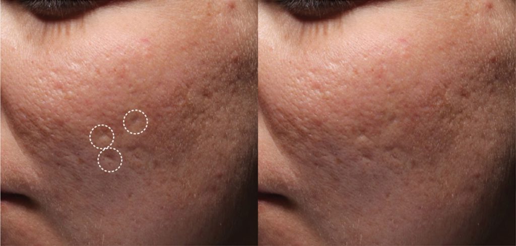 Bellafill (formerly Artefill) - Michael Echavez MD in Seattle WA 98109