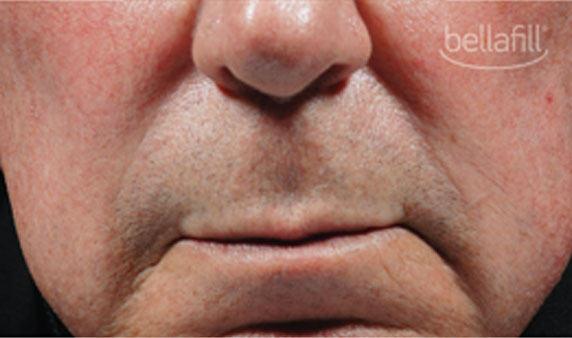 Bellafill (formerly Artefill) - Michael Echavez MD in Seattle WA 98109